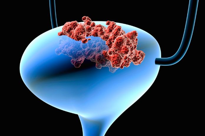 Bladder Cancer - A Disease Of Older Men?