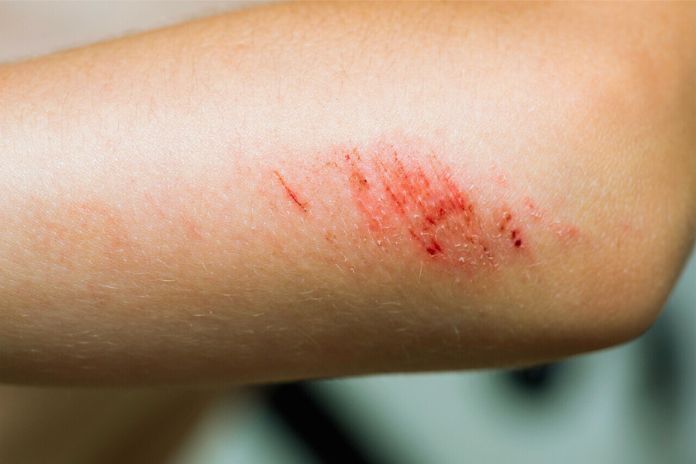 Wounds, Burns, Grazes: What To Do?