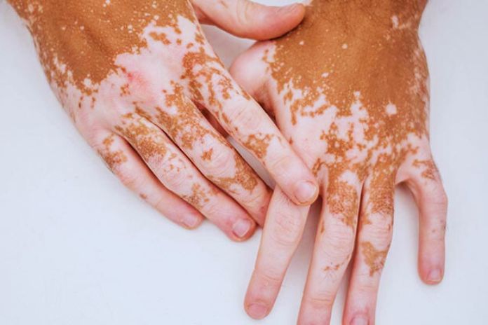 Vitiligo: Causes, Treatments, And Prevention
